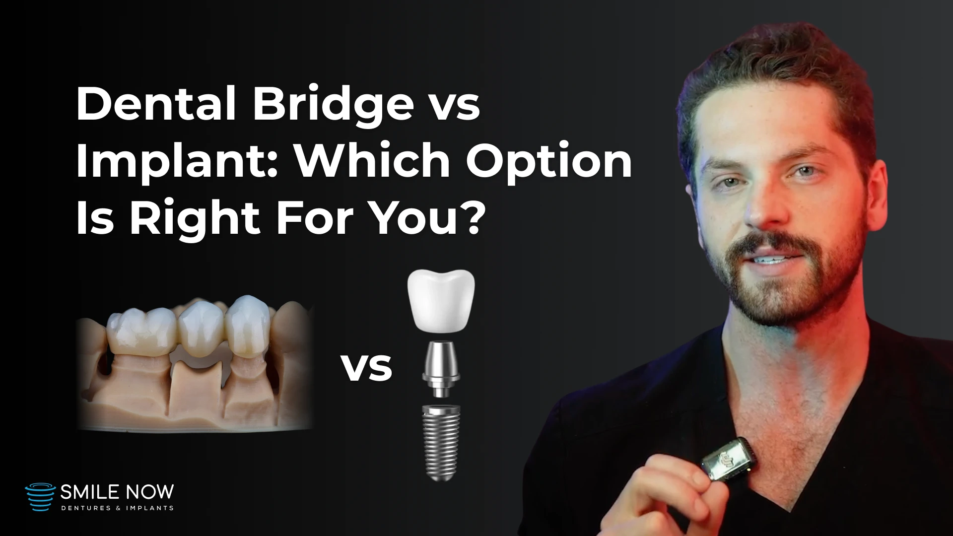 Dental Bridge Vs Implant: Which Tooth Replacement Option Is Right For ...